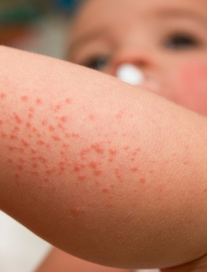 Newborn & Paediatric Skin Problems - Eudelo